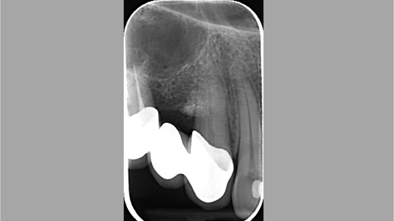 Regeneration of an intrabony defect using collprotect® membrane ...